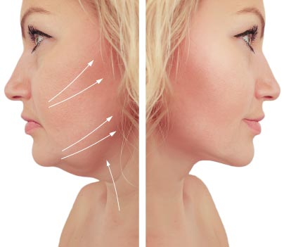 Double Chin Removal Surgery in India| Advanced Treatment