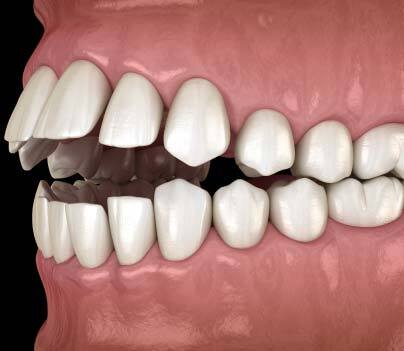 Advanced Open Bite Correction from Pristyn Care Orthodontists