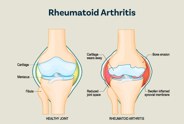 Gallbladder Stones Treatment - Diagnosis, Surgery & Recovery