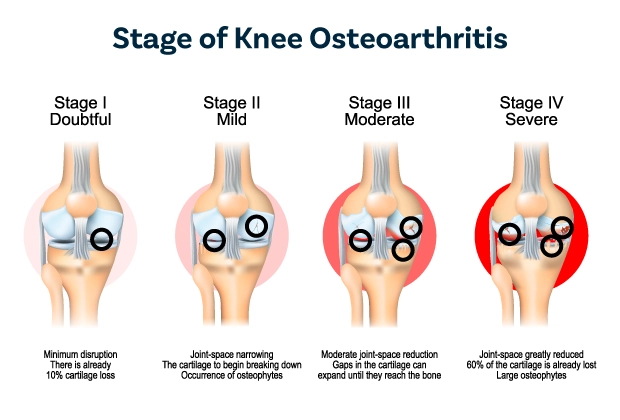 Hydrocele Surgery Before And After Frontiers | Laparoscopic Vs. Open