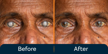 Cataract Surgery Before and After Pictures