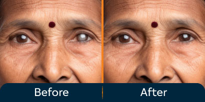 Cataract Surgery Before and After Pictures