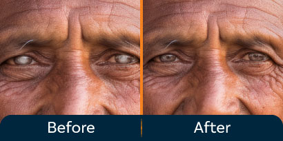 Cataract Surgery Before and After Pictures