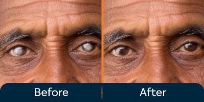 Cataract Surgery Before and After Pictures