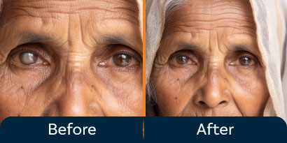 Cataract Surgery Before and After Pictures