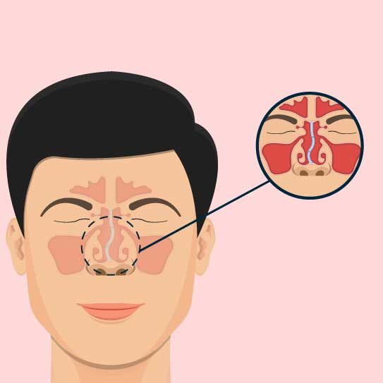 Septoplasty Surgery in Mumbai - Book Your Consultation Now