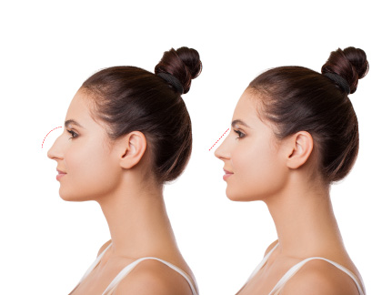 Advanced, Minimally Invasive Rhinoplasty Treatment- Enhance Nose Shape